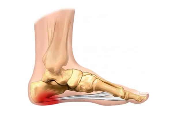 ¿Qué es la Fascitis Plantar y porqué produce dolor en el talón ...