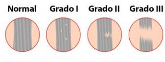 ¿Qué es y cómo se trata un esguince de tobillo? – Clinica Fixen