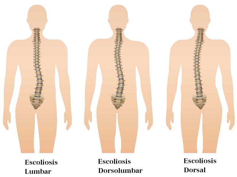 Qué Es La Escoliosis Conoce Los Síntomas Y Tratamientos Clinica Fixen